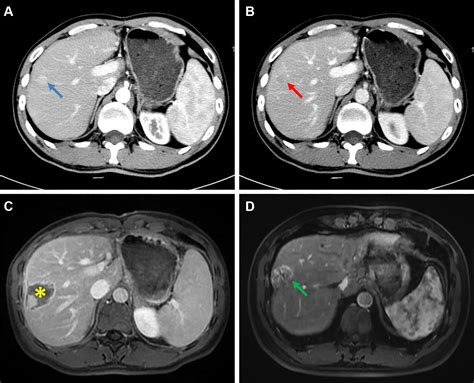 Transarterial Chemoembolization With Radiofrequency Ablation Versus