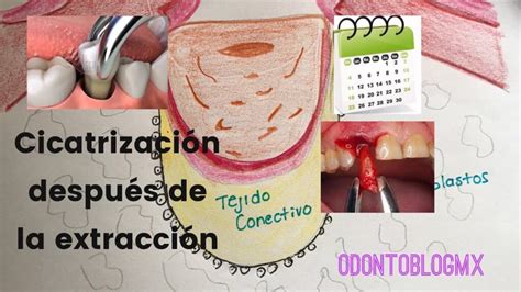 Descubre cuánto tiempo tarda en cerrar una extracción de muela y