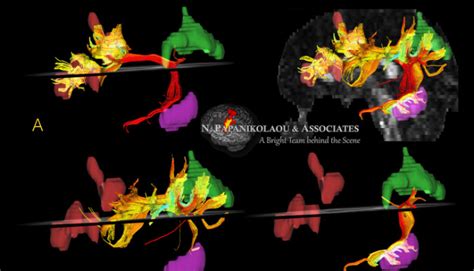 Structural Connectivity Of Language Network