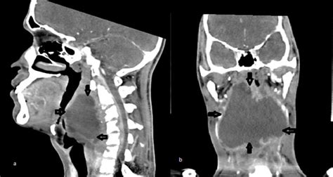 Retropharyngeal Tuberculosis Abscess A Case Report And Review Of The Literature