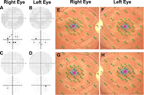 Grayscale And Pattern Deviation Of The Humphrey Field Analyzer 102 Download Scientific Diagram