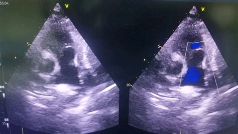 Alexandre D On Linkedin Pulmonic Stenosis