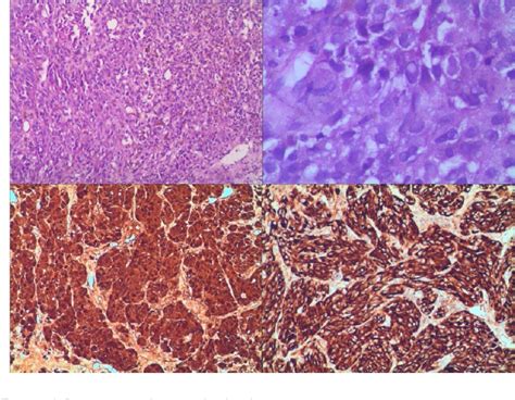 Figure 2 From Pelvis Metastasis From Primary Choroidal Melanoma A Case Report Semantic Scholar