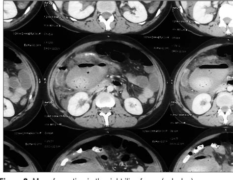 Figure 2 From Congenital Mesenteric Defect Causing Volvulus And Intestinal Obstruction In An