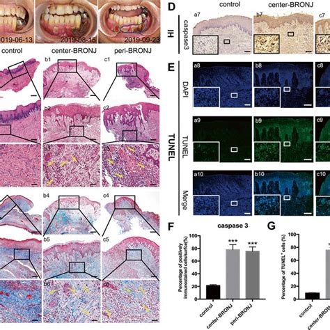 Histological Analysis Of Gingival Tissues From Bronj Patients And Download Scientific Diagram