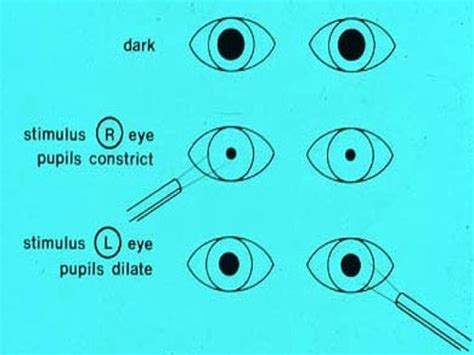 Week 4 Pupillary Iris And Ciliary Body Abnormalities Flashcards Quizlet