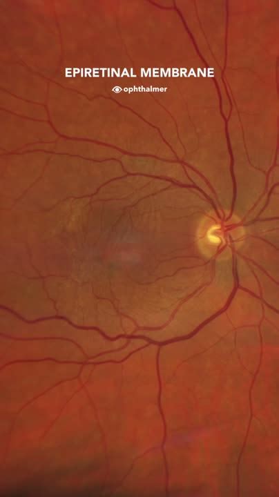 Mohammed Alharbi Od On Linkedin 👁️ Epiretinal Membrane Erm Key