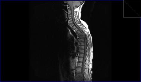 Metastatic Spinal Cord Compression Mri Radiology Article