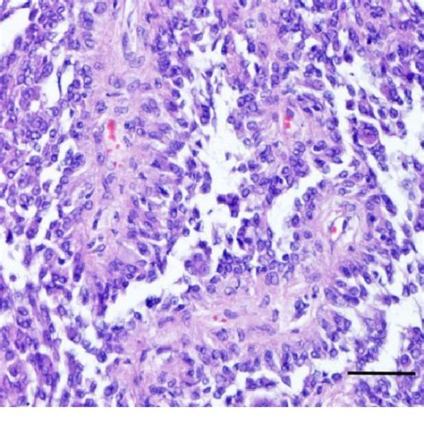 Brain Papillary Meningioma The Tumor Is Characterized By A