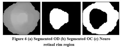 An Efficient Detection System For Screening Glaucoma In Retinal Images