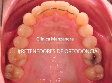 Retenedores Dentales Tipos De Retenedores Ortodoncia