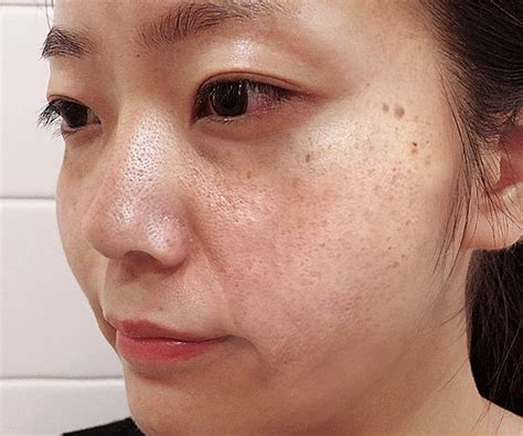 【芸能人・モデルの必需品】シミ・シワ・毛穴をなくす最強美白パウダーって？ ヒルドイド フェイス