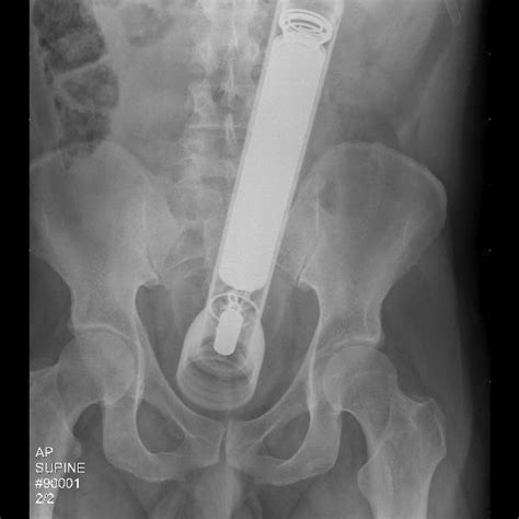 Foreign Body Radrounds Radiology Network