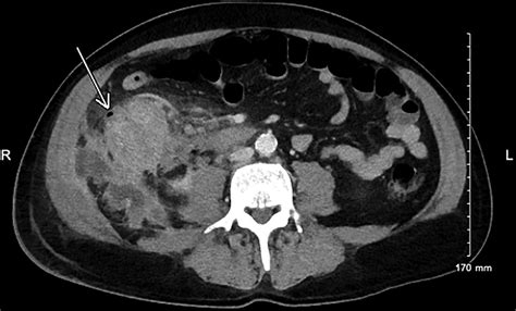 Microsatellite Instability In Colorectal Cancer The Evolvin