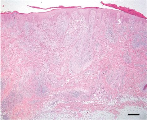 Tick Bite Granuloma Recommendations For Surgical Treatment Pmc