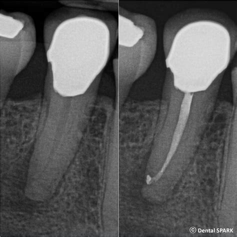 Dental Spark This Patient Developed Acute Apical Abscess