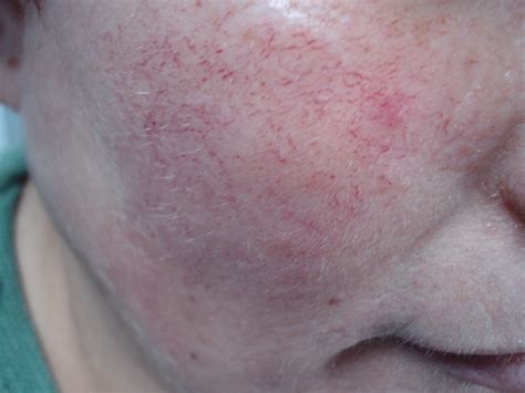 Skin Atrophy Face