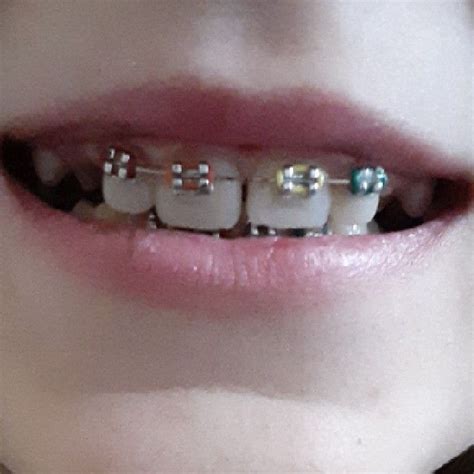 Colourful Braces Colours Brackets Dentales Ortodoncia Brackets