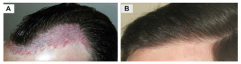 How To Get A Natural Looking Hair Transplant Wimpole Clinic