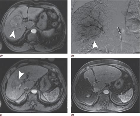94 Interventional Radiology Abdominal Key