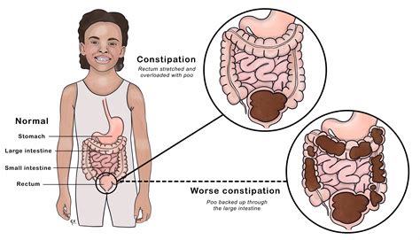 Constipation Symptoms Causes And Home Remedies Homeopathy360