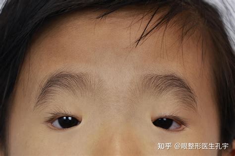 什么是小睑裂综合征？ 知乎
