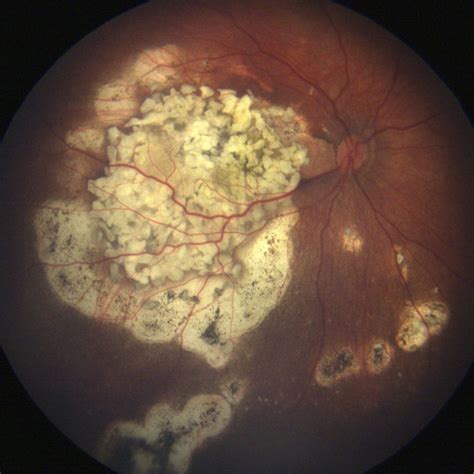 Researchers Discover New Molecular Driver Of Retinoblastoma Newsroom