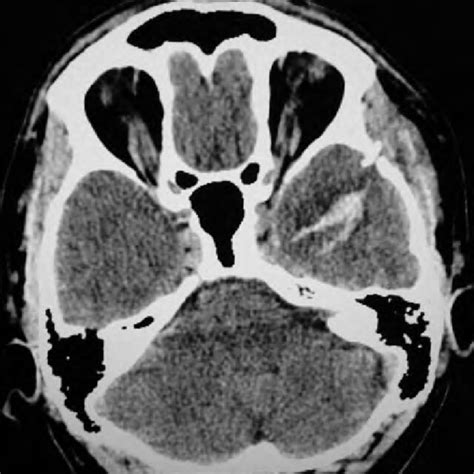 Non Contrasted Cranial Ct Scan Showing Left Squamous Bone Temporal Download Scientific Diagram