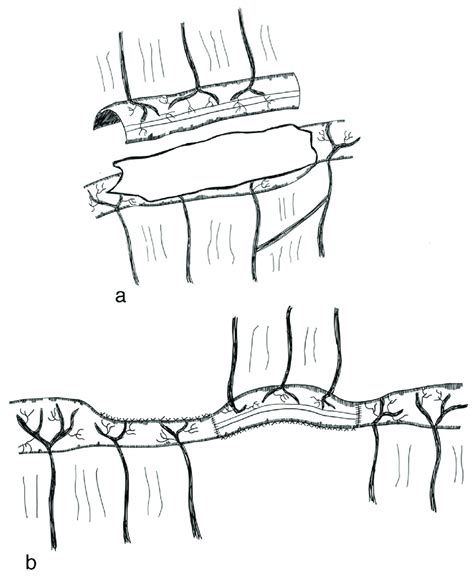 A Isolation Of 30 Cm Colon Segment Longitudinal Cut Along The
