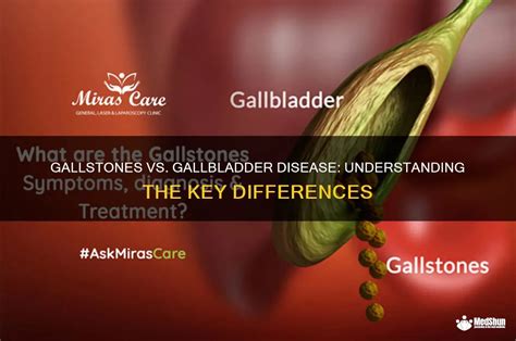 Gallstones Vs Gallbladder Disease Understanding The Key Differences