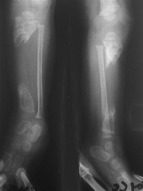 Non Vascularised Fibular Transfer In The Management Of Defects Of Long Bones After