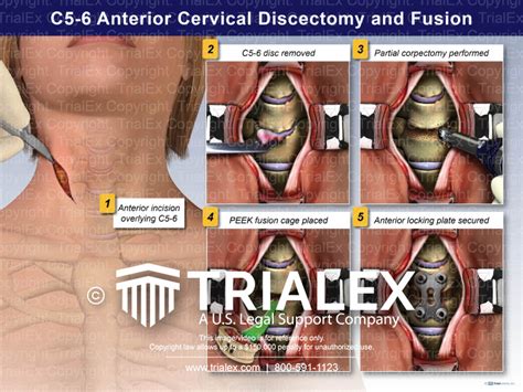 C5 6 Anterior Cervical Discectomy And Fusion Trialquest Inc