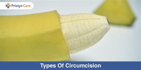 V Cut Circumcision