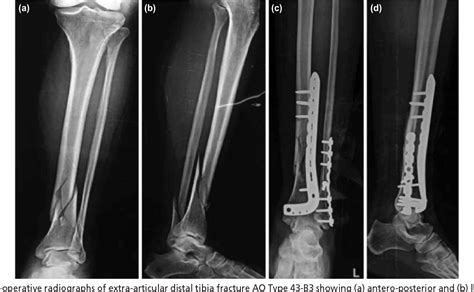 Pdf Minimally Invasive Osteosynthesis Of Distal Tibia Fractures Using