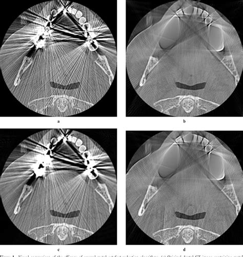 Figure 1 From Dental Ct Metal Artefact Reduction Based On Sequential Substitution Semantic
