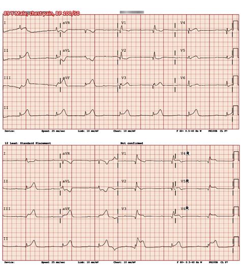 Dont Forget To Obtain The Right Side Ecg In Patients With Inferior