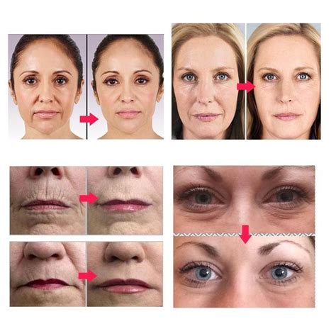 List 100 Pictures Dermaroller Before And After Pictures Superb
