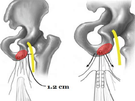 Posterior View Of Pelvis And Proximal Hamstring Footprint Red