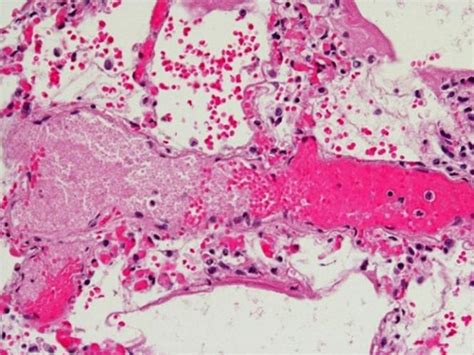 Haematoxylin And Eosin Stained Post Mortem Lung Sections Thrombotic