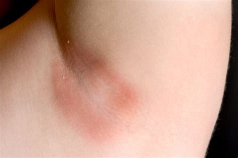 Dermdx Moderately Itchy Underarm Rash Clinical Advisor