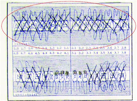 Odontogram Of The Suspect Completely Edentulous Maxilla In Initial Download Scientific Diagram