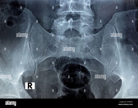 Sacroiliac Joint Digital Radiograph Examination X Ray Reveals Preserved