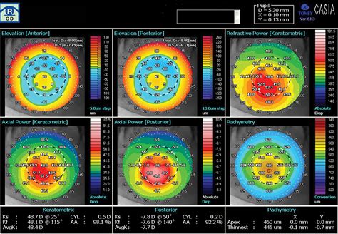 Normal Corneal Topography