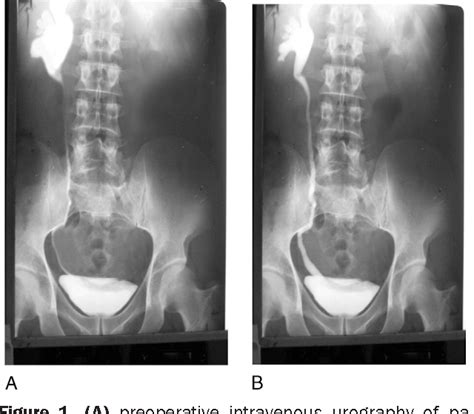 Figure 1 From Buccal Mucosa Graft For Ureteral Stricture Substitution Initial Experience