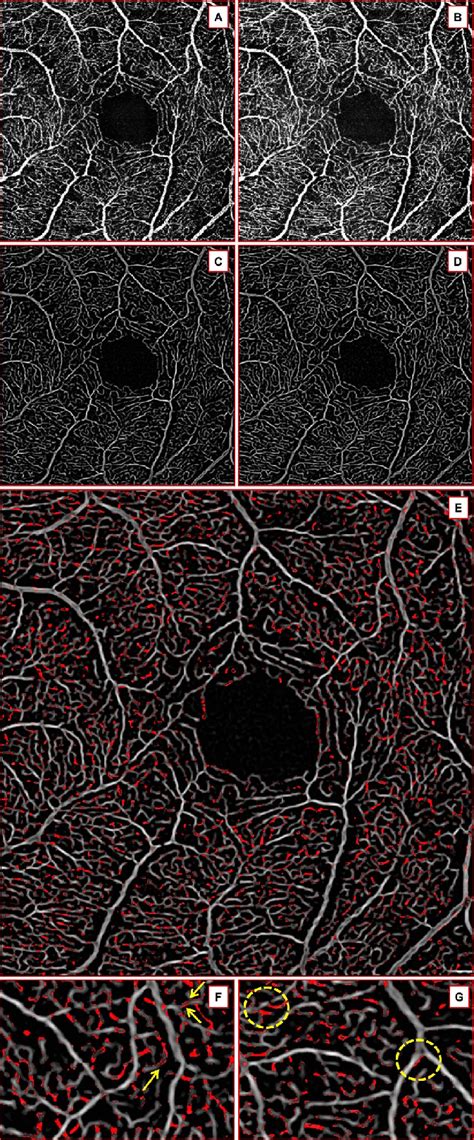 A G En Face OCT Angiography In A CSCR Case Assessment Of The SCP At Download Scientific