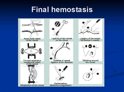 Lecture Bleeding Methods Of Hemostasis L Yu Ivashchuk