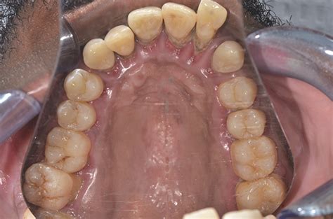 Treating Severe Chronic Periodontitis Inside Dentistry