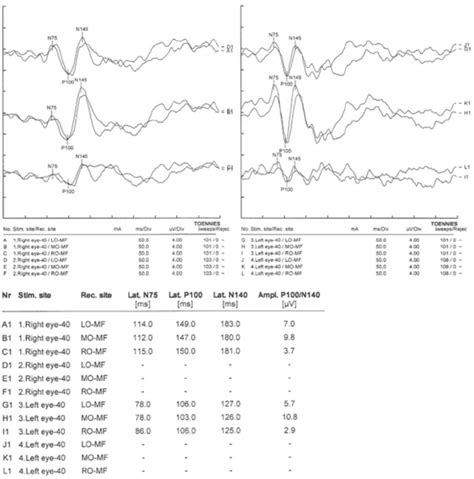 Pattern Reversal Visual Evoked Potentials Test Shows Prolonged P100