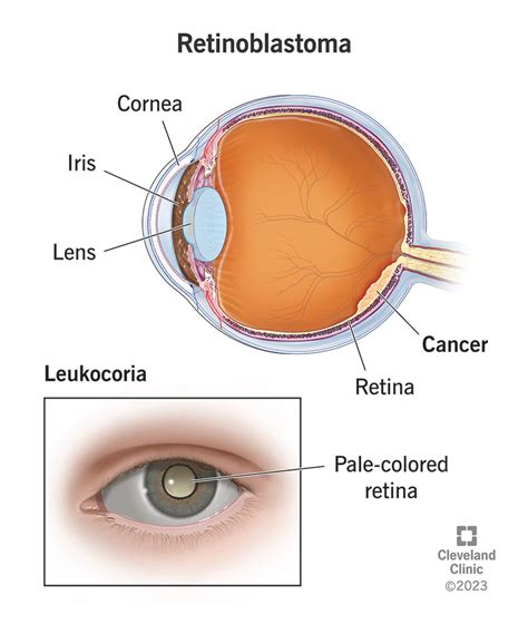 Retinoblastoma Symptoms Treatment