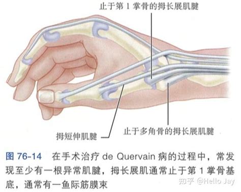 狭窄性腱鞘炎 知乎